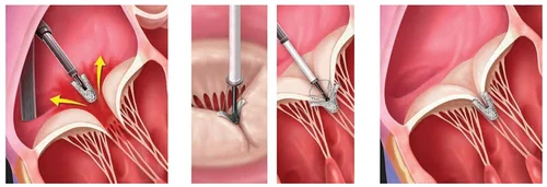 Tricuspid Clip (TriClip), TEER (Transcatheter Edge-to-Edge Repair of the Tricuspid leaflet ...