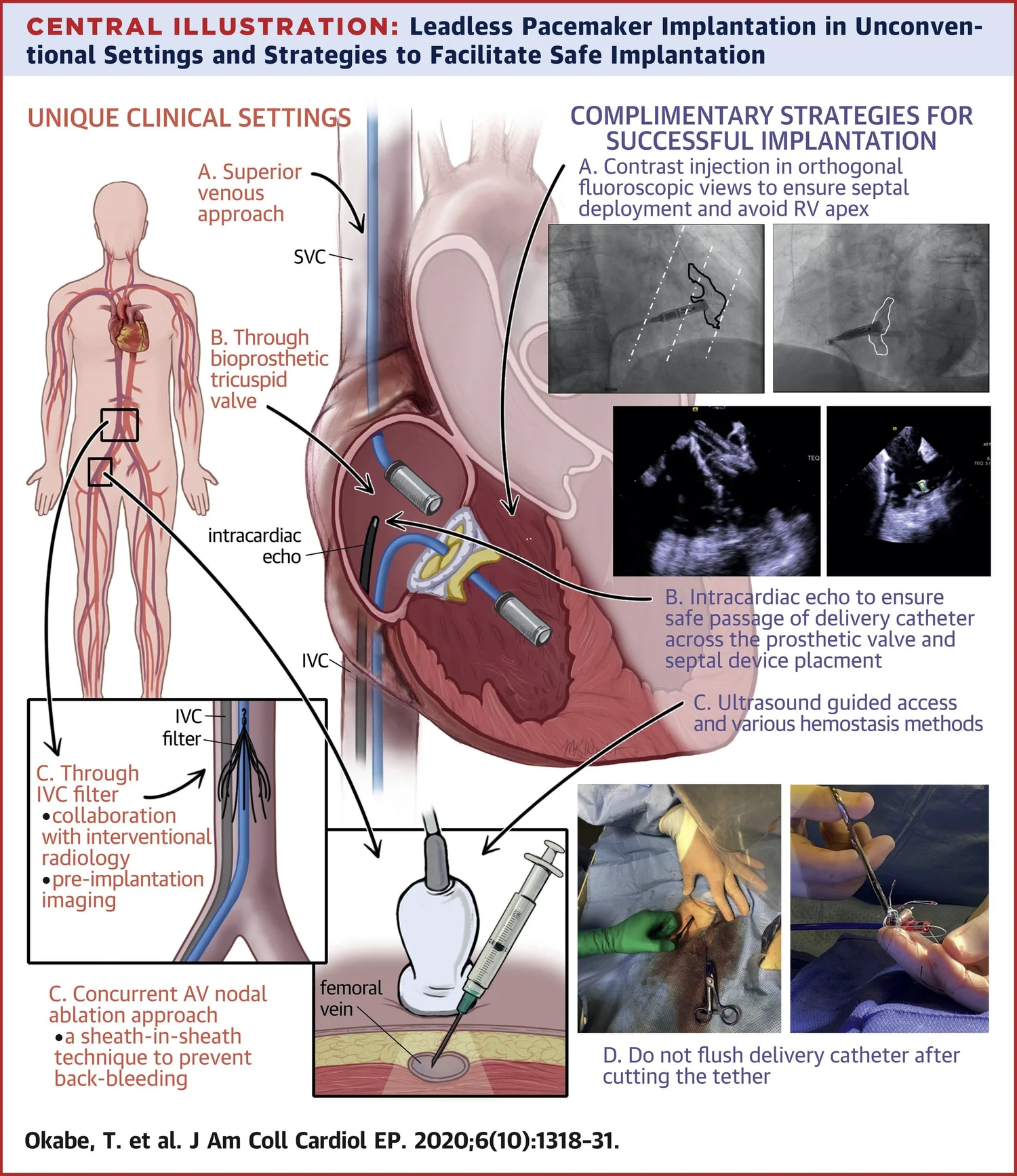 Extraction of Leadless Pacemaker — Golden Shutter Films