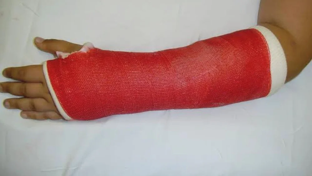 Fibreglass Casts — SmartMoves Physiotherapy and Health Services - Inner ...