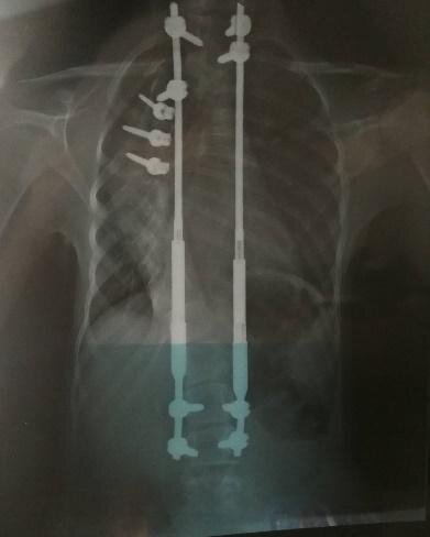 The Growing Rod — The Official Website of Dr. Rick Hodes