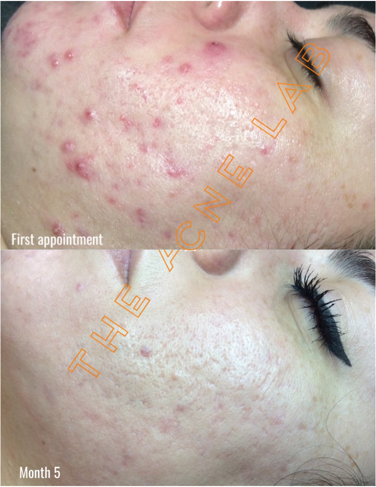 Cystic Acne — The Acne Lab