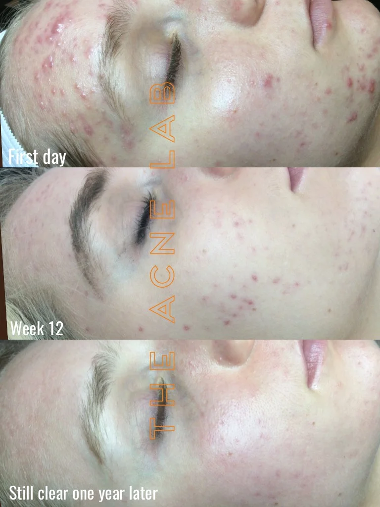 Hyperkeratinization Acne
