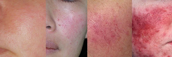 Mild Rosacea Acne