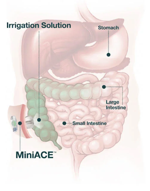 About Ostomies — Ostomy Halifax