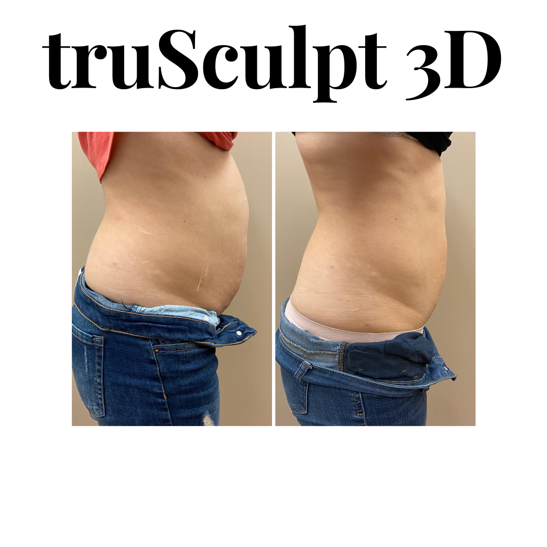 Body Sculpting With The Trusculpt 3d — Self Medical Spa