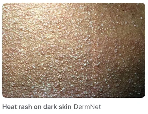 Heat Rash vs. Eczema: What's the Difference? — Uptown Dermatology