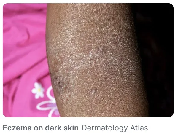 Heat Rash vs. Eczema: What's the Difference? — Uptown Dermatology