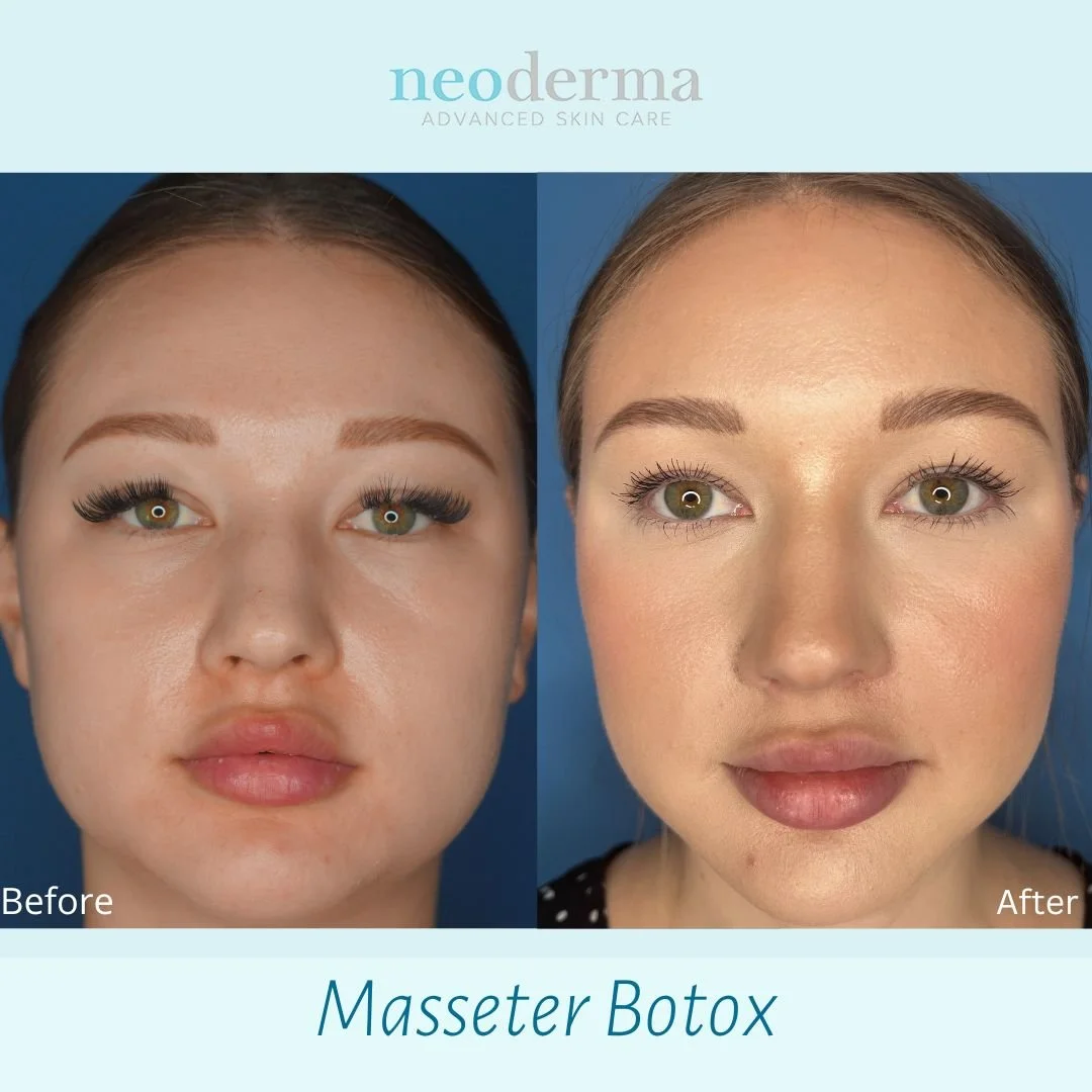 Botox — Neoderma Advanced Skin Care