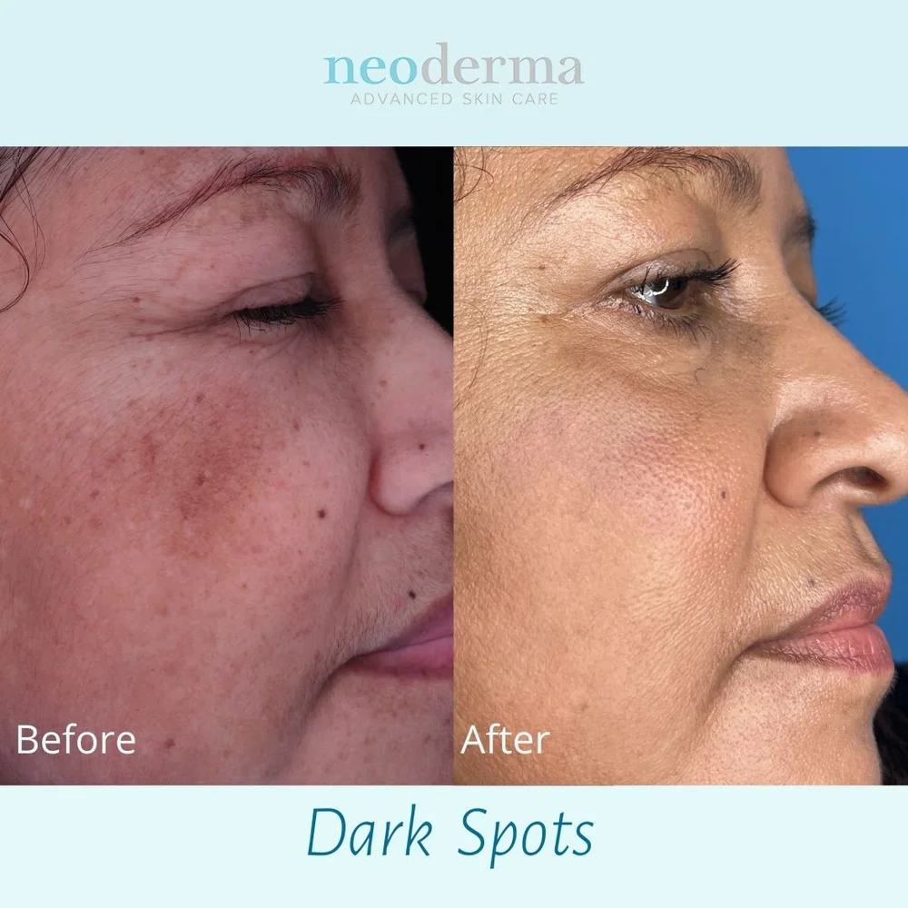 Customized Skin Care — Neoderma Advanced Skin Care