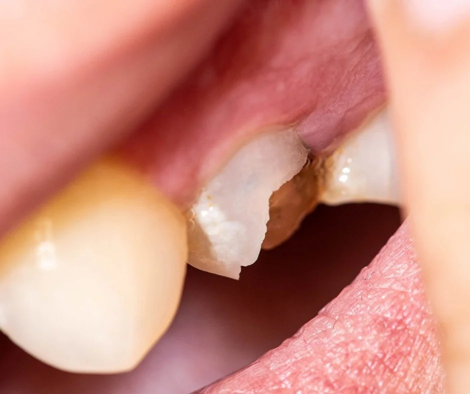 6 Best Treatments By the Dentists For a Chipped Tooth — KWC Dental