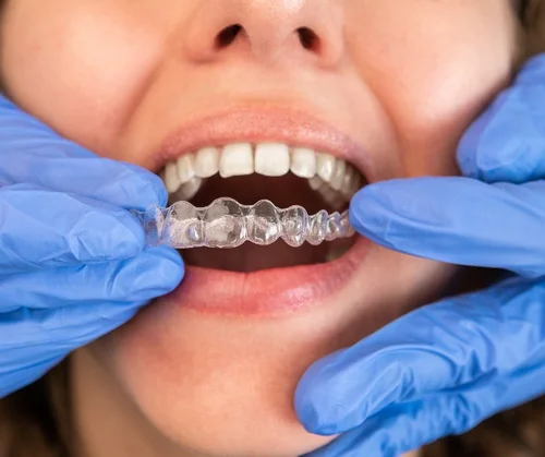 Invisalign: Straighten Your Teeth Discreetly | KWC Dental - KWC Dental