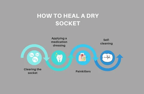 9 Effective Solutions: Dry Socket Treatment at Home — KWC Dental