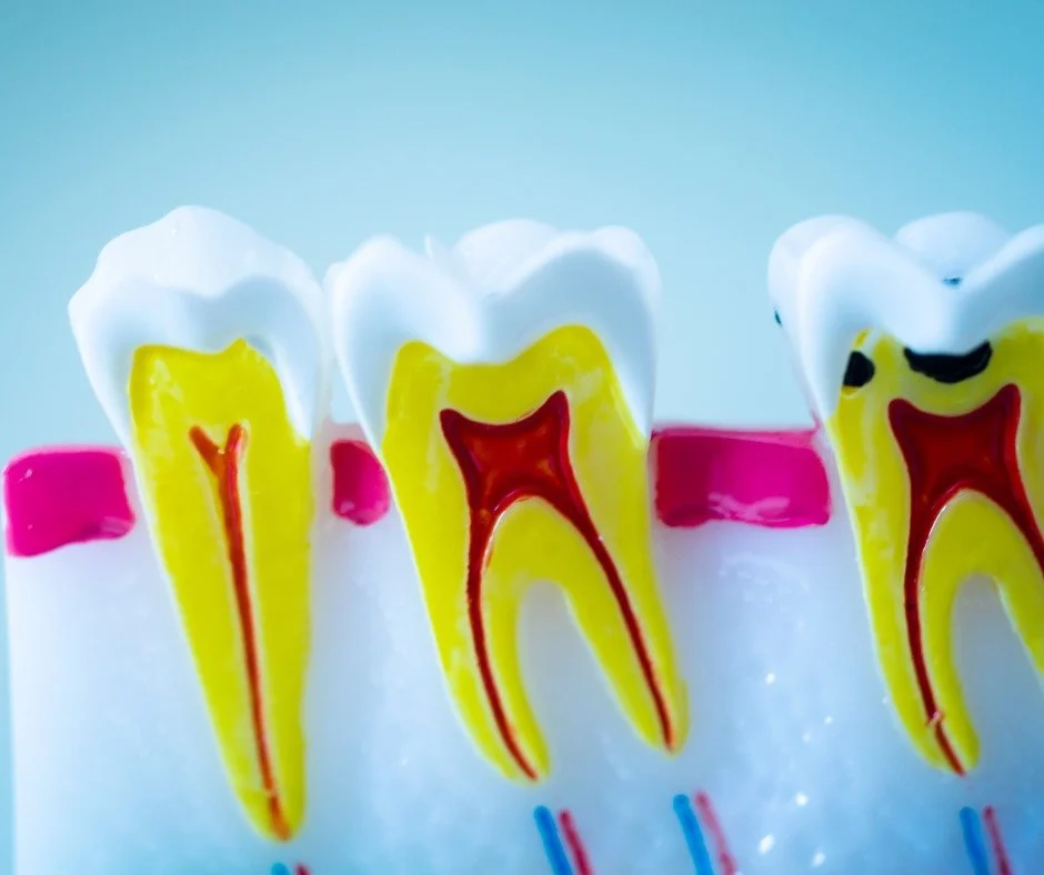 Signs of Dental Decay for Better Teeth Care — KWC Dental