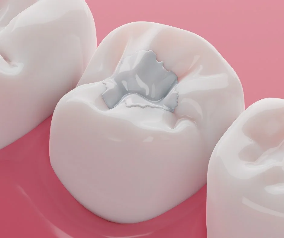 Composite Fillings: How Long do They Last — KWC Dental