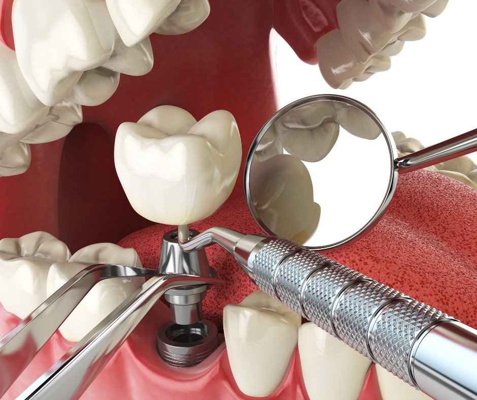 Single-Tooth Denture: Is It the Right Solution for You? — KWC Dental