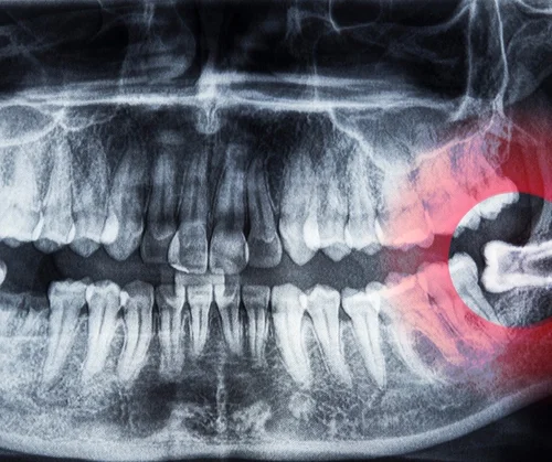 From Childhood to Adulthood: When Do Wisdom Teeth Grow In — KWC Dental