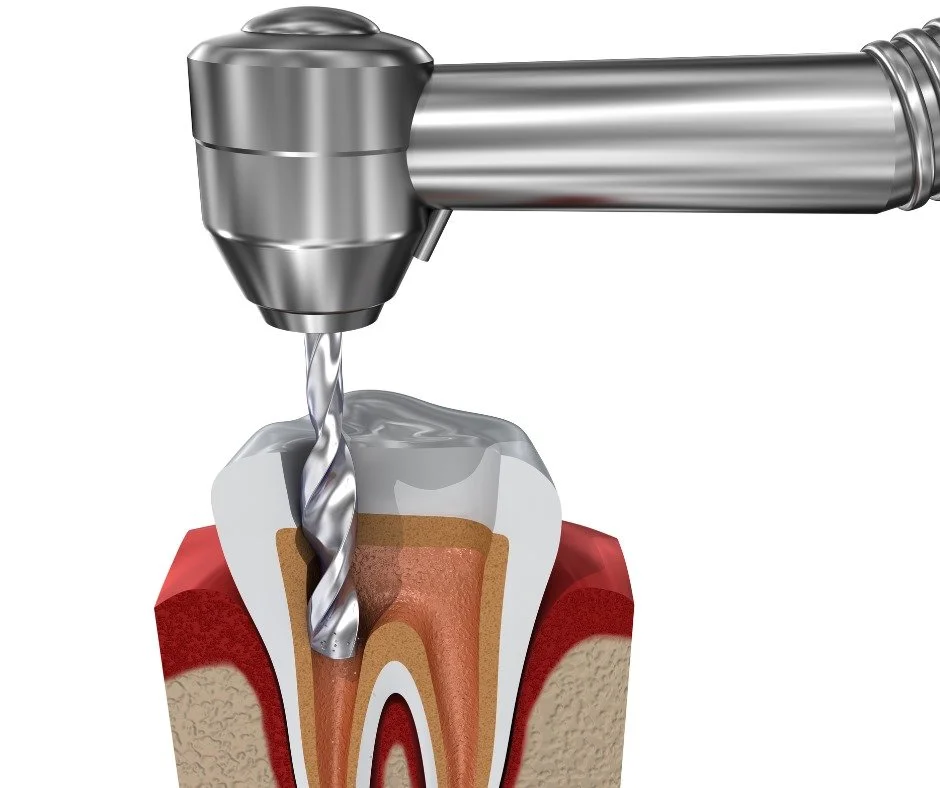 Useful Tips on How to Avoid Root Canal | KWC Dental — KWC Dental
