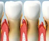 5 Receding Gums Stages & the Treatment Options — KWC Dental
