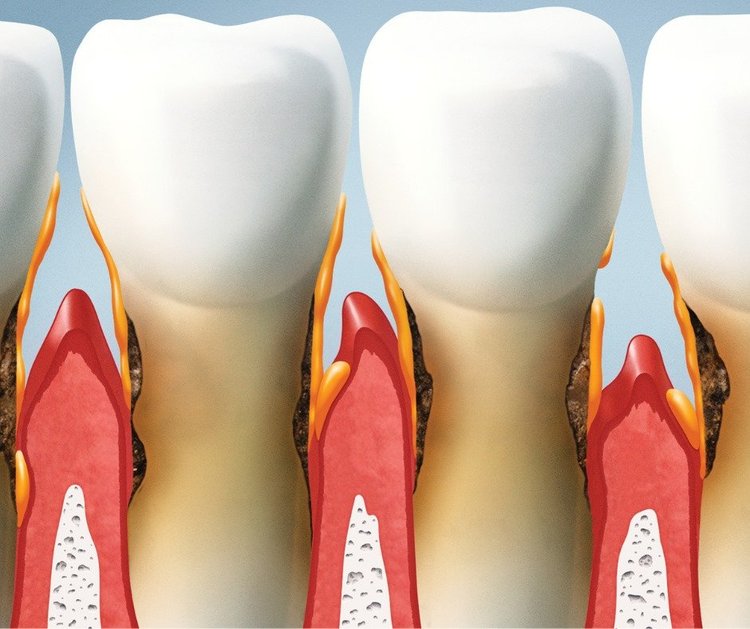 5 Receding Gums Stages & the Treatment Options — KWC Dental