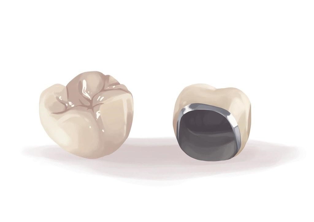 The Beginner’s Guide To A PFM Crown — KWC Dental