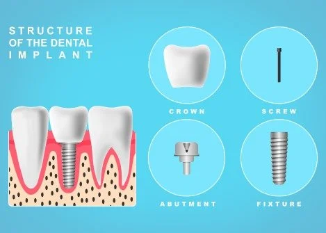 A Detailed Guide on All-on-4 Dental Implants | KWC Dental - KWC Dental