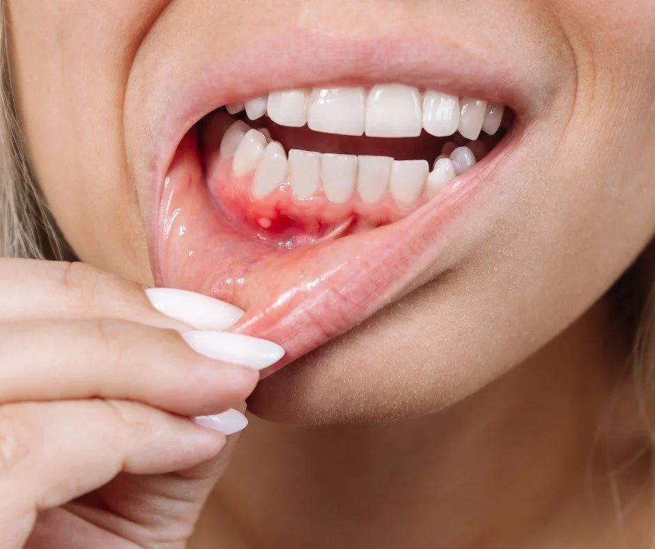 Gum Boil: 9 Symptoms & How To Get Rid Of It — KWC Dental