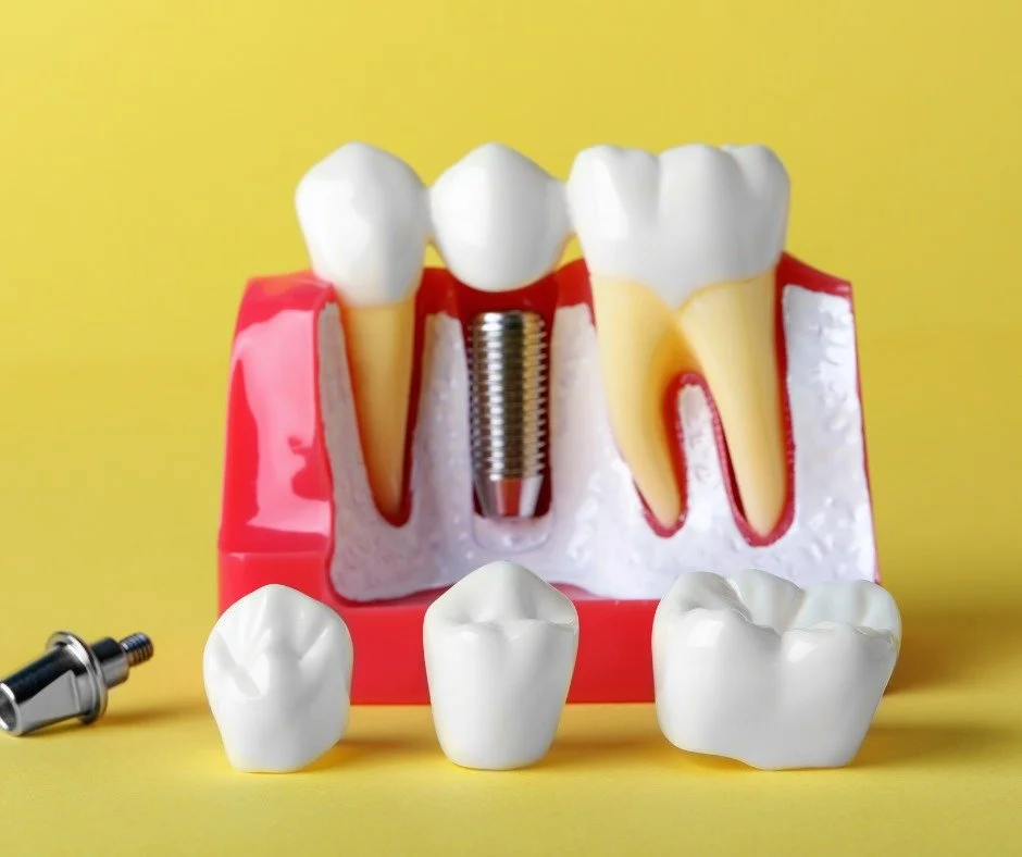 3 Most Popular Teeth Replacement Options For You - KWC Dental