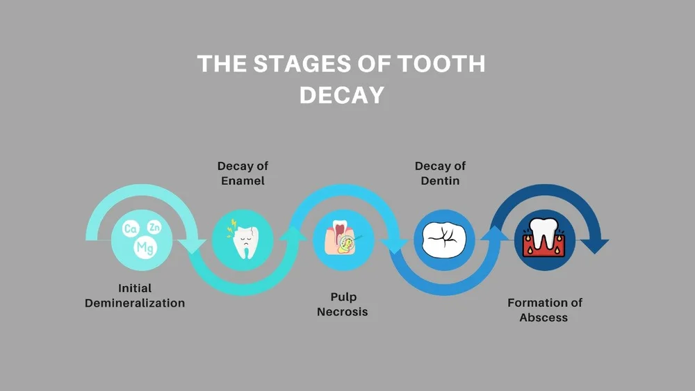 Cavity Symptoms: Why Dental Care Matters More Than Ever — KWC Dental