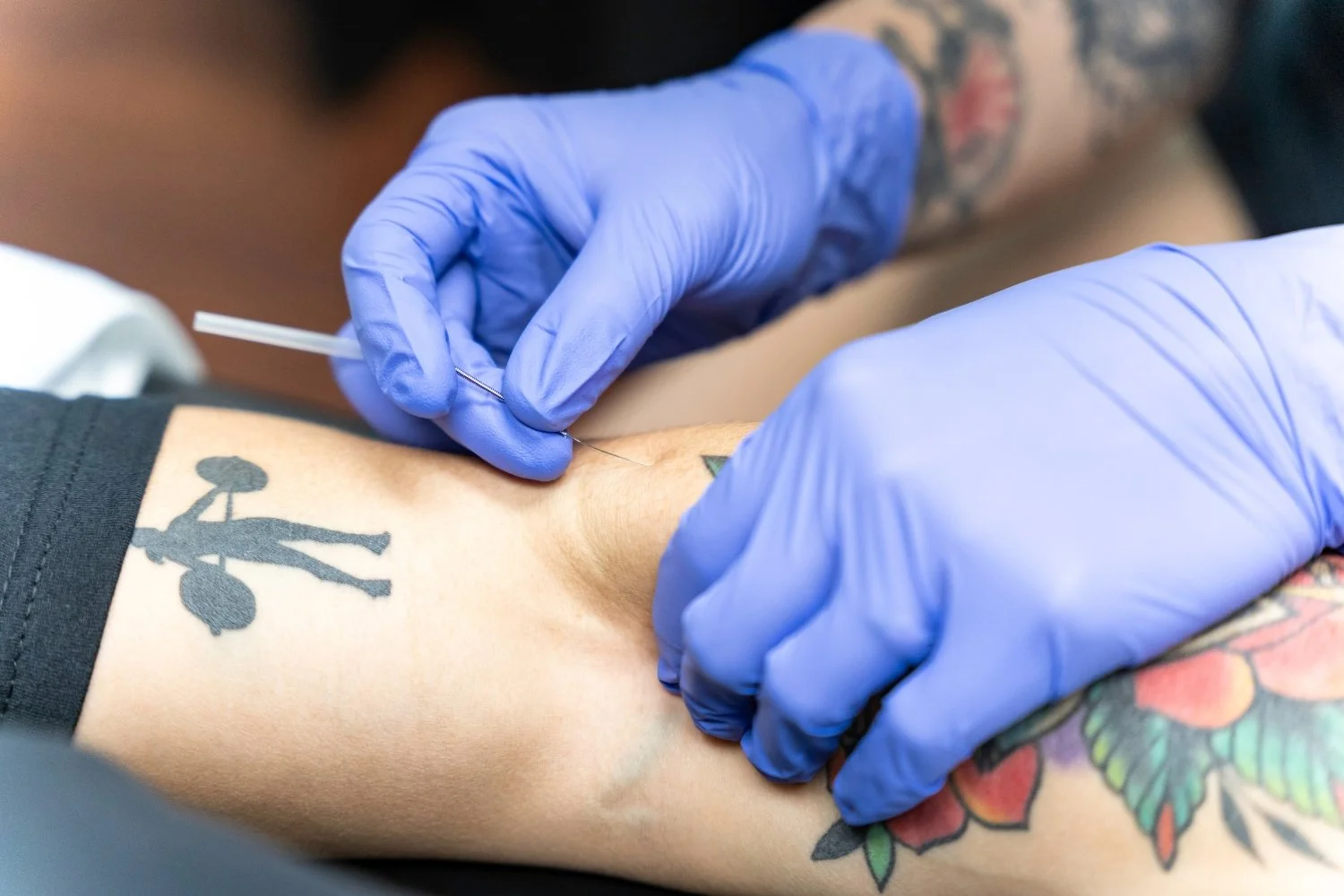 What is dry needling? A guide for athletes — Samson Physical Therapy