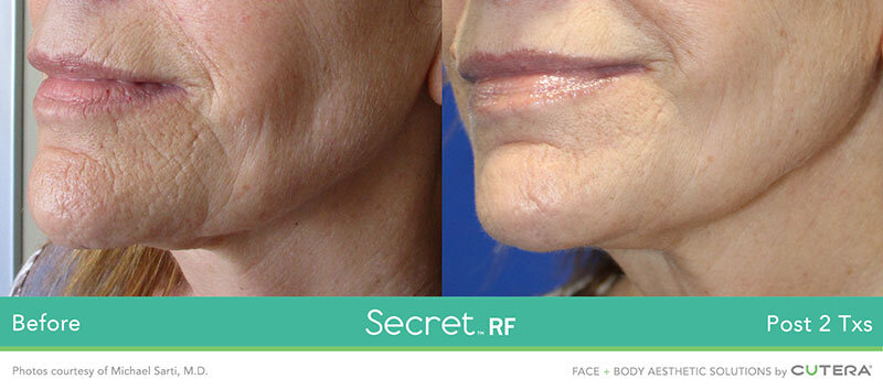 Secret RF (Radiofrequency Microneedling) — Nu Image Medical Esthetics