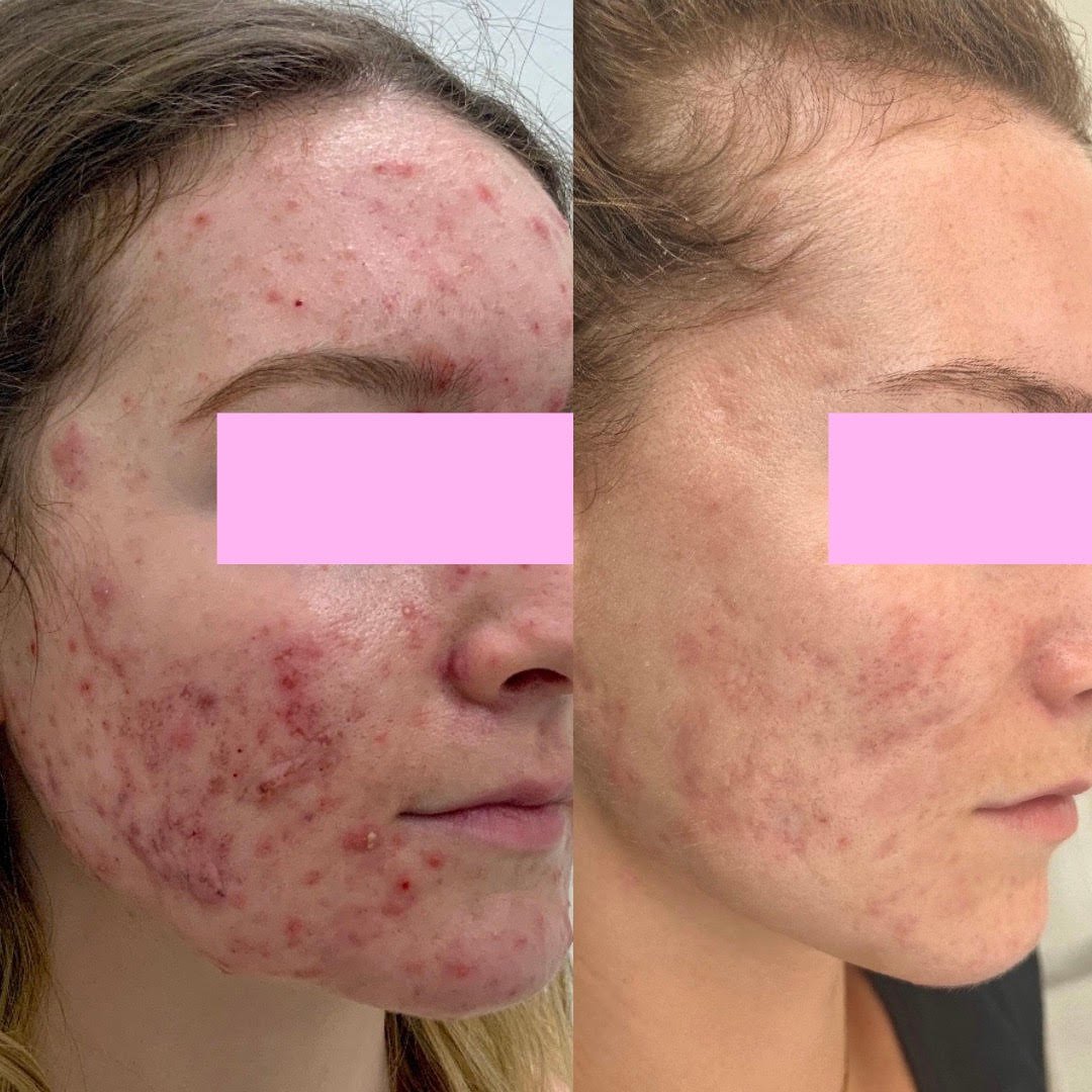 Laser Acne Treatment — Nu Image Medical Esthetics