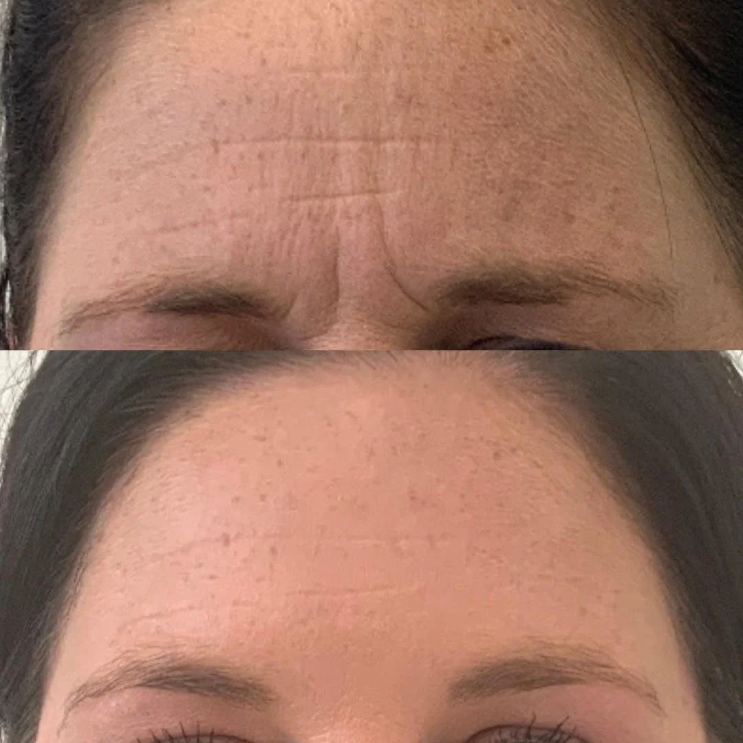 Wrinkles Gallery — Nu Image Medical Esthetics
