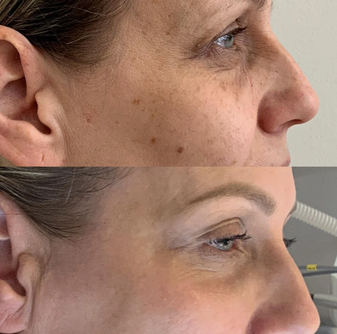 Laser Eye Rejuvenation — Nu Image Medical Esthetics