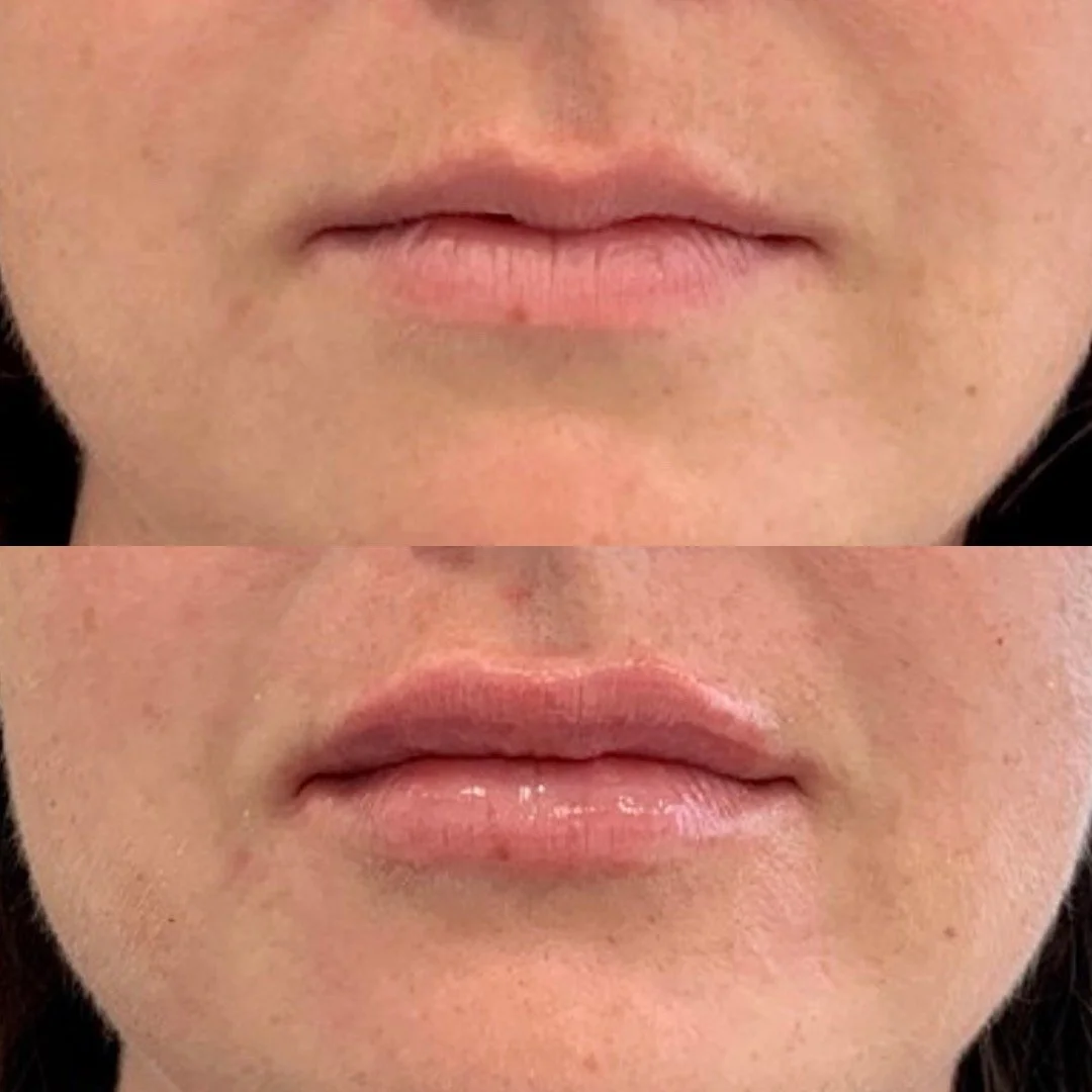 Lip Injections — Nu Image Medical Esthetics