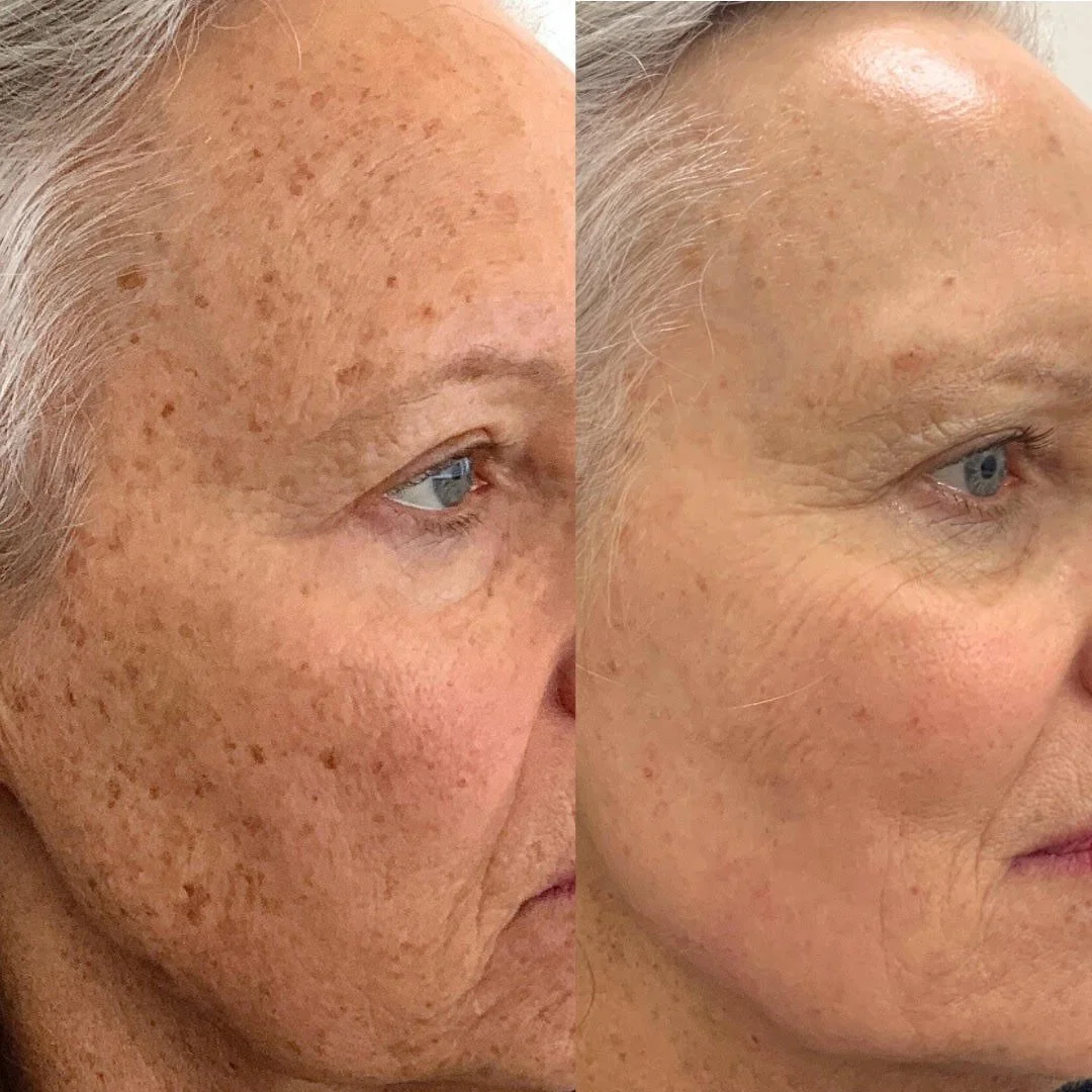 Pigmentation & Sun Damage Gallery — Nu Image Medical Esthetics