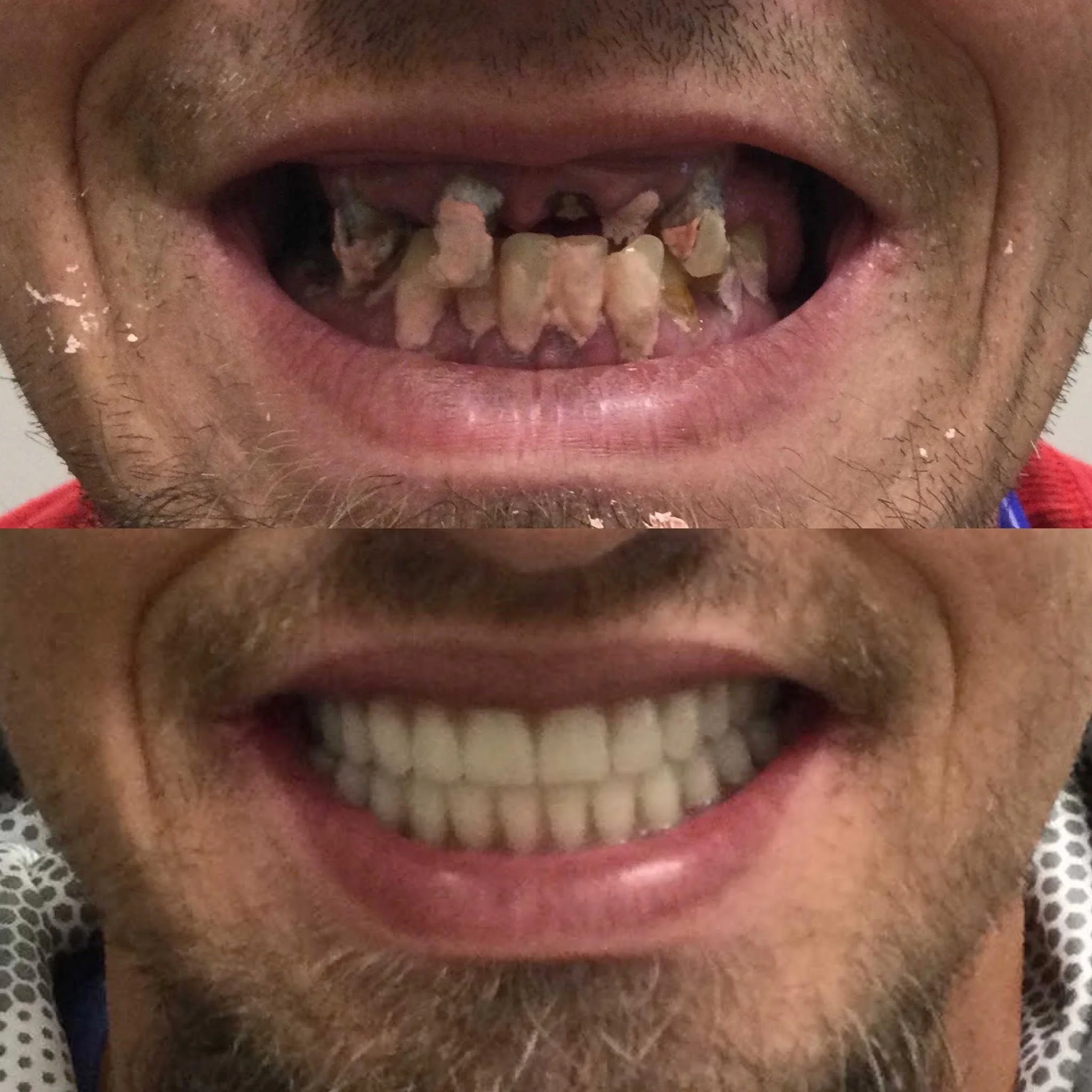Immediate Dentures Memphis Dentures And Implants