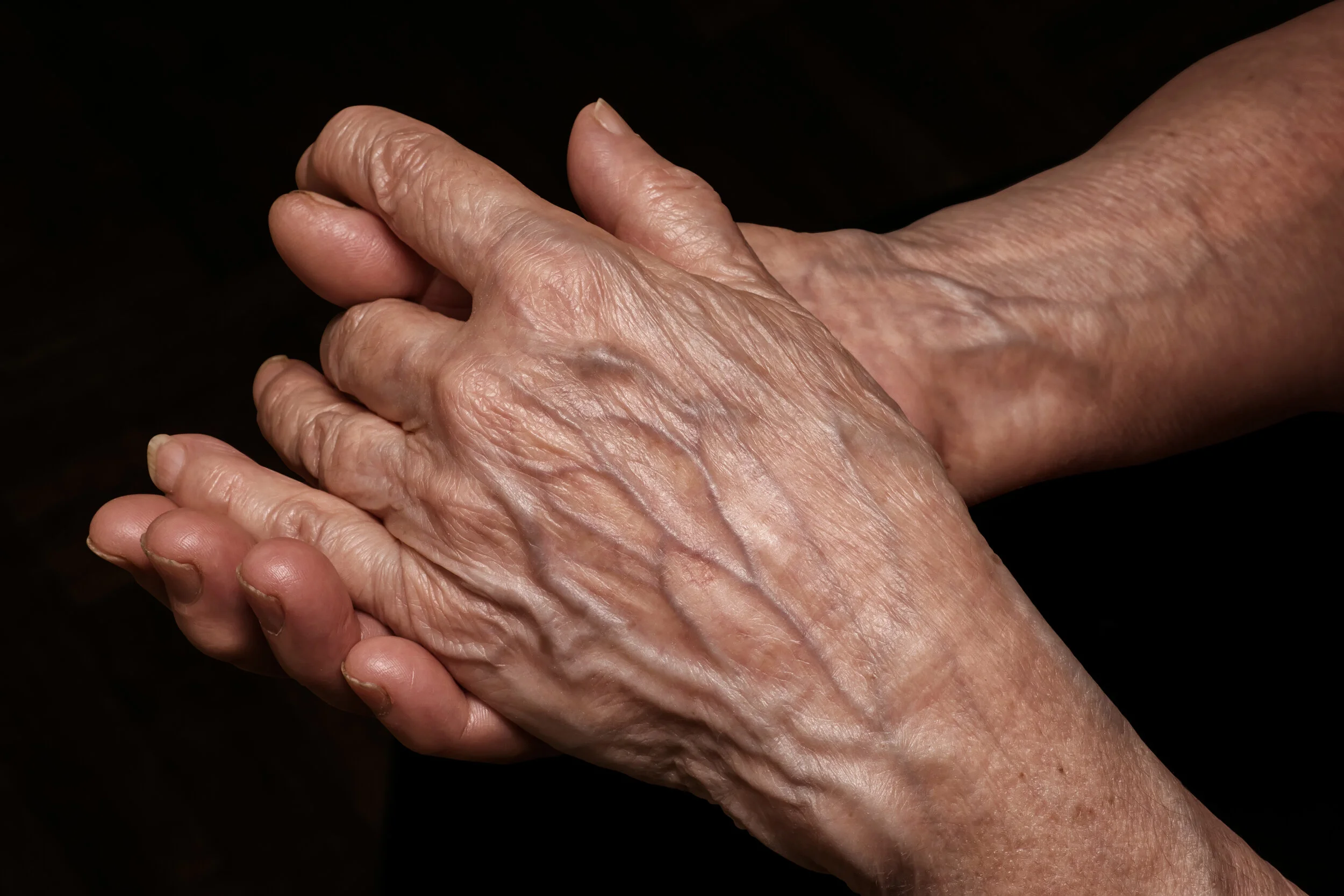 Wrinkly Hands Pacific Coast Dermatology Wellness Center