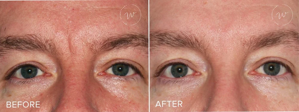 Lip | Dermal Fillers | Vancouver BC | West Dermatology