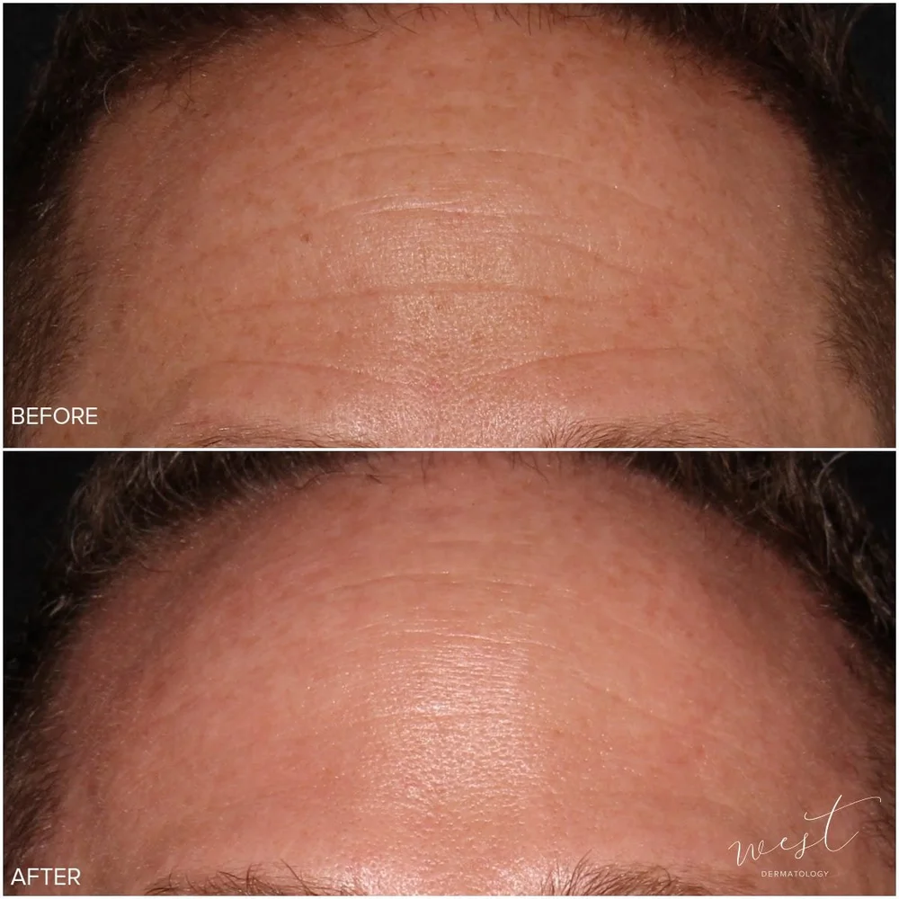 Botox and Fillers 101: Understanding the Basics | West Dermatology