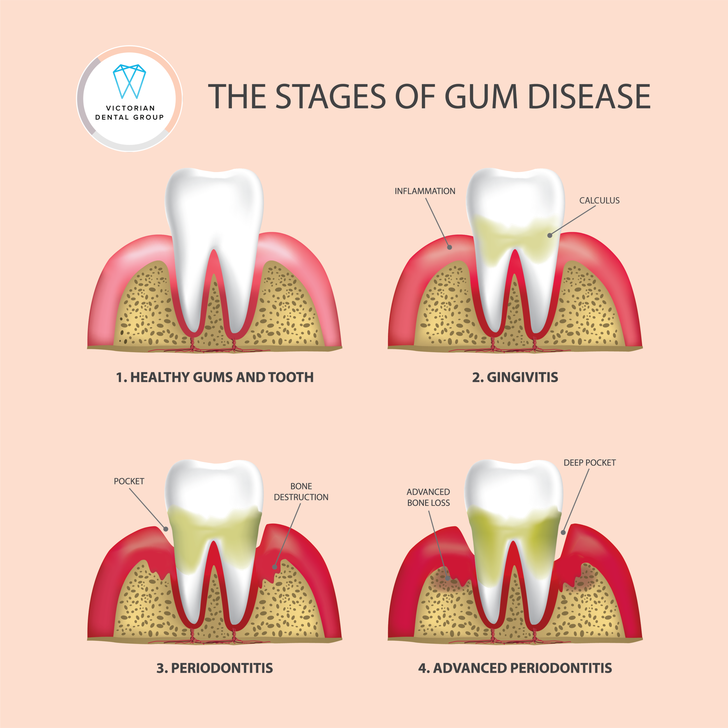 GUM CARE AND PERIODONTICS Malvern East | General Dentist Toorak | VDG