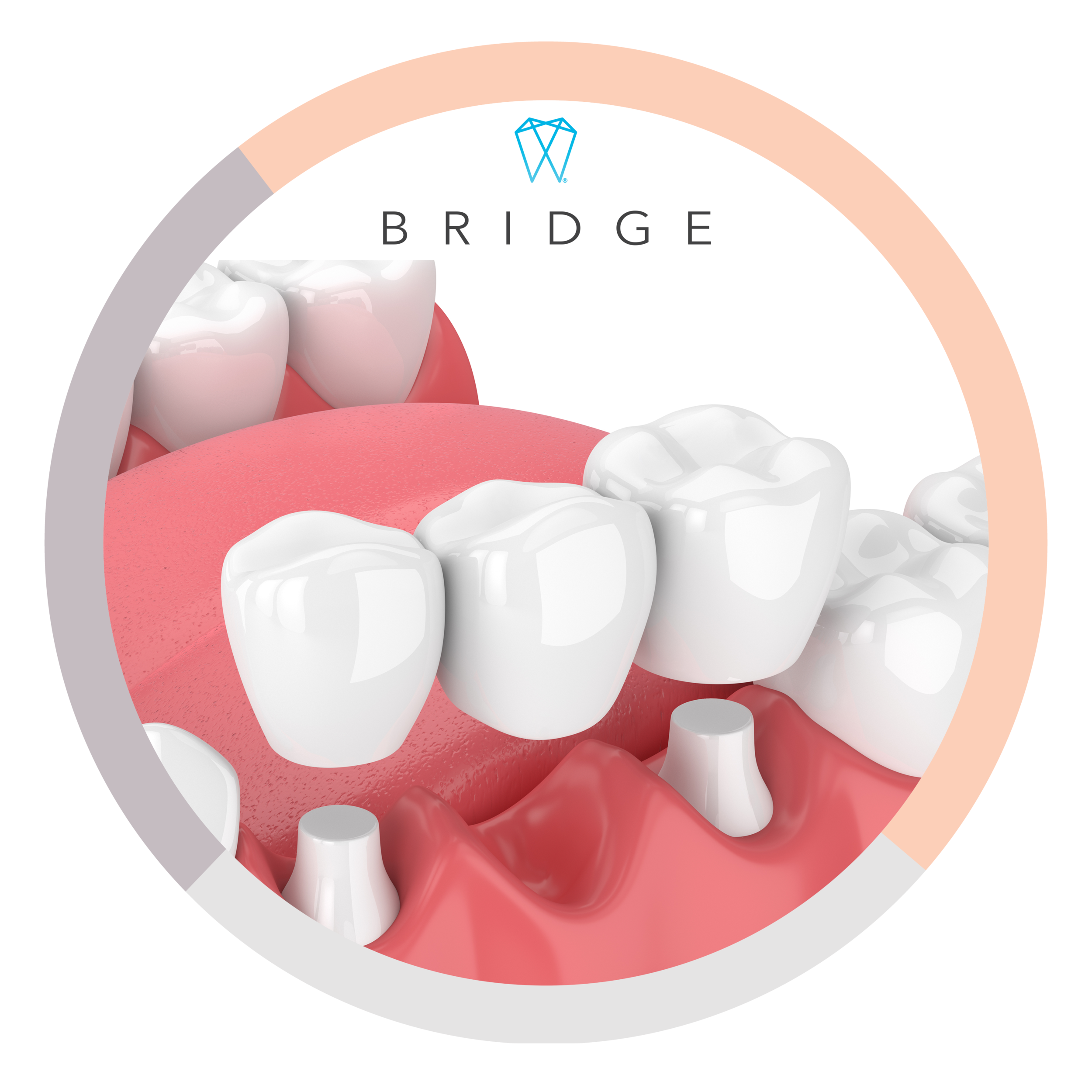 DENTAL BRIDGE