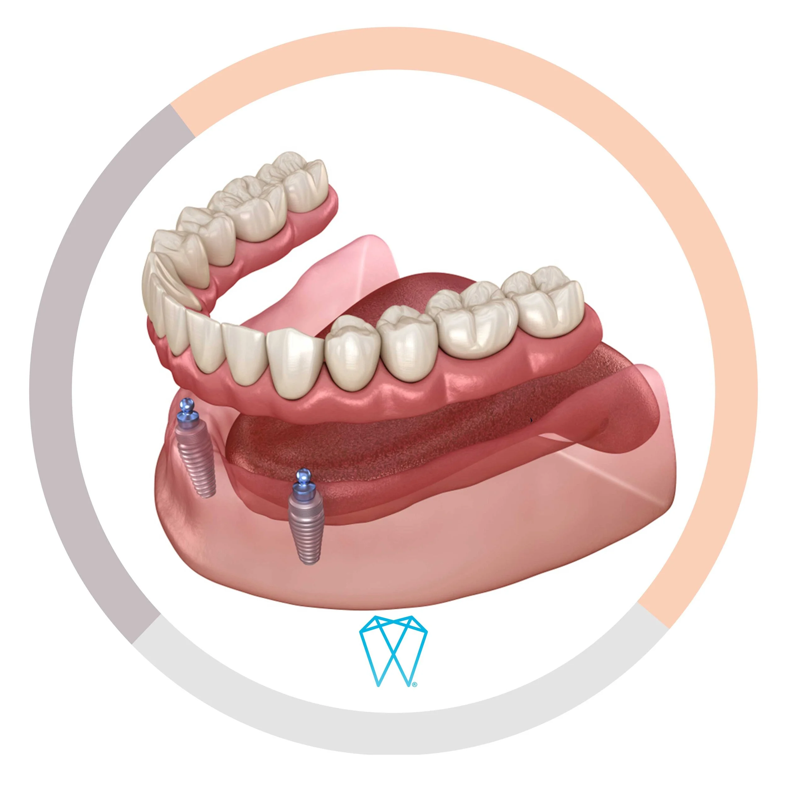 IMPLANT DENTURES | SPECIALIST PROSTHODONTIST - MALVERN EAST