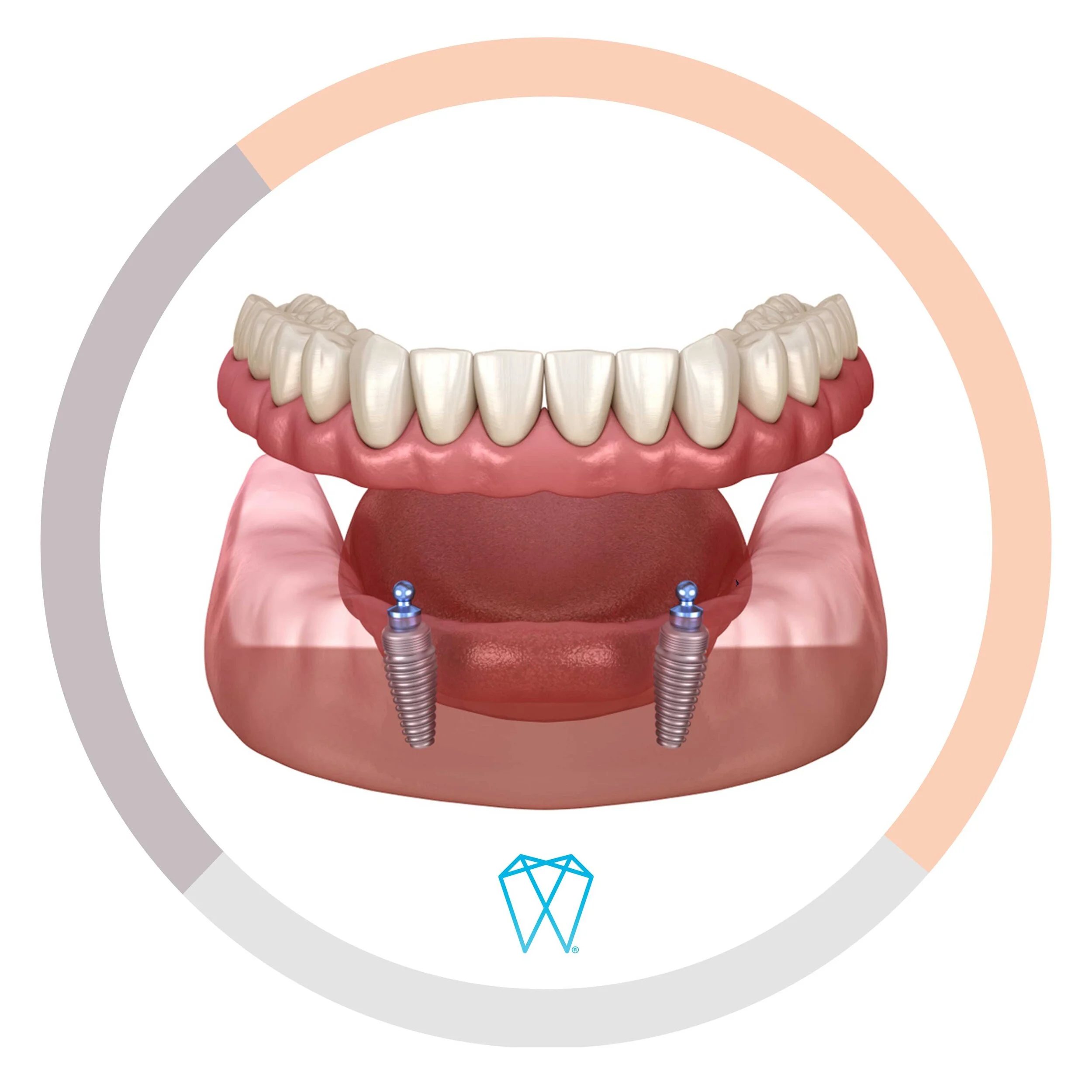 IMPLANT DENTURES | SPECIALIST PROSTHODONTIST - MALVERN EAST