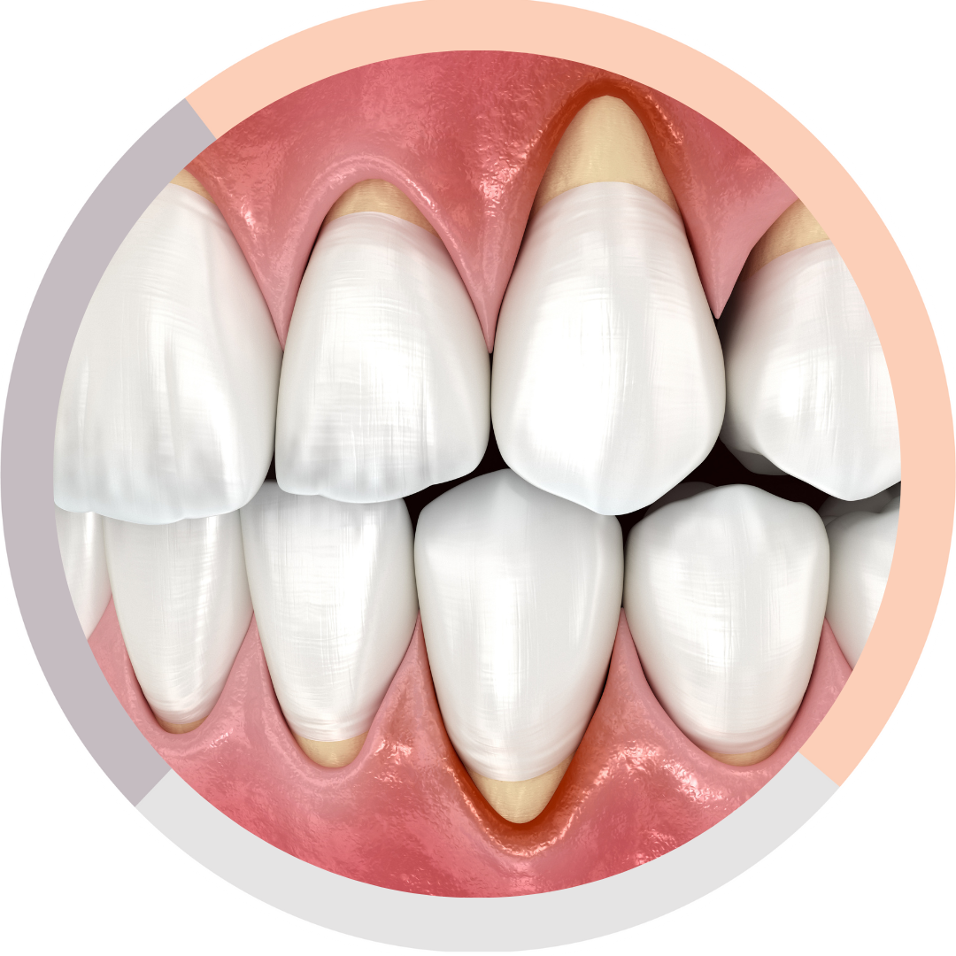 Bleeding/Swollen Gums - What to do Next? Melbourne Dentist in Malvern East