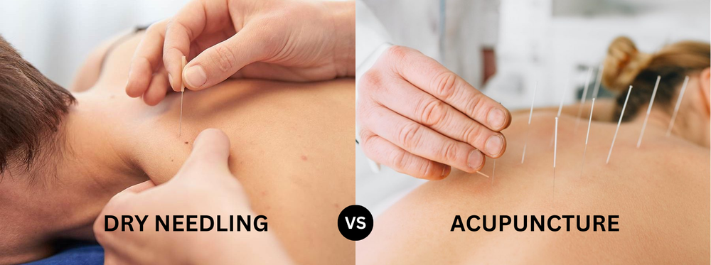 PHYSIO 101 — Dry Needling vs. Acupuncture