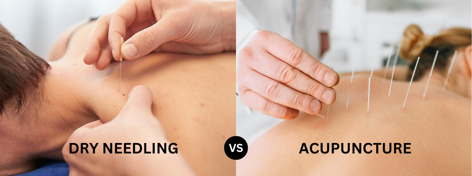 PHYSIO 101 — Dry Needling vs. Acupuncture