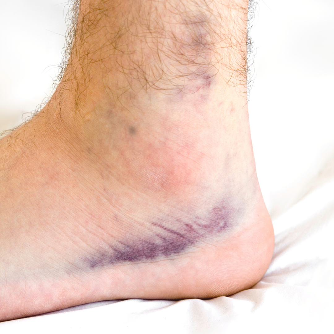 Ankle Sprain Don t RICE Here s What Will Actually Help Midwest