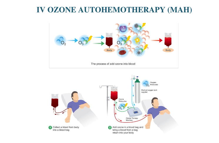 Blood Ozone Therapy/ Major Autohemotherapy (MAH) CMN Hospital — CMN Advanced Cancer Treatment