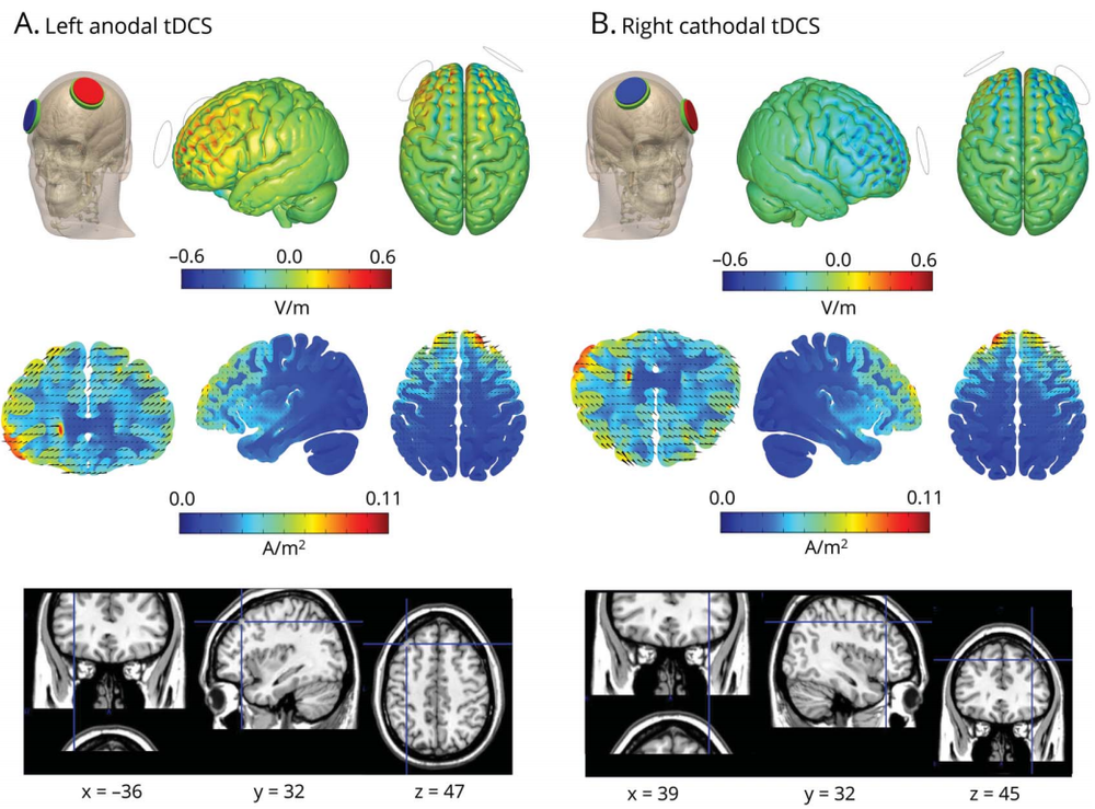 Dorsolateral Prefrontal Cortex Tdcs