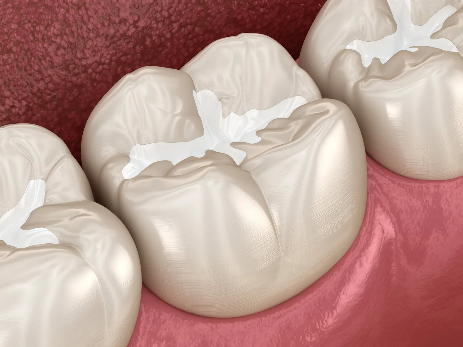 What are fissure seals? - Dental on Cambridge